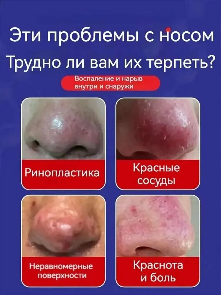 Крем от розацеаисцеление красный нос и прыщи