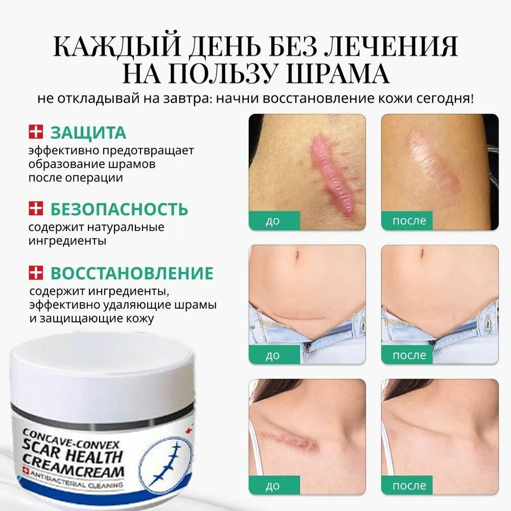 Крем-гель от шрамов, рубцов, растяжек, травм и пигментации, мазь от следов прыщей для лица и тела