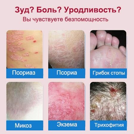 Мазь от псориаза / Крем для ухода за кожей при псориазе, 20 г, экземе и герпесе, акне, ожогах, порезах, от прыщей на лице, укусов насекомых.