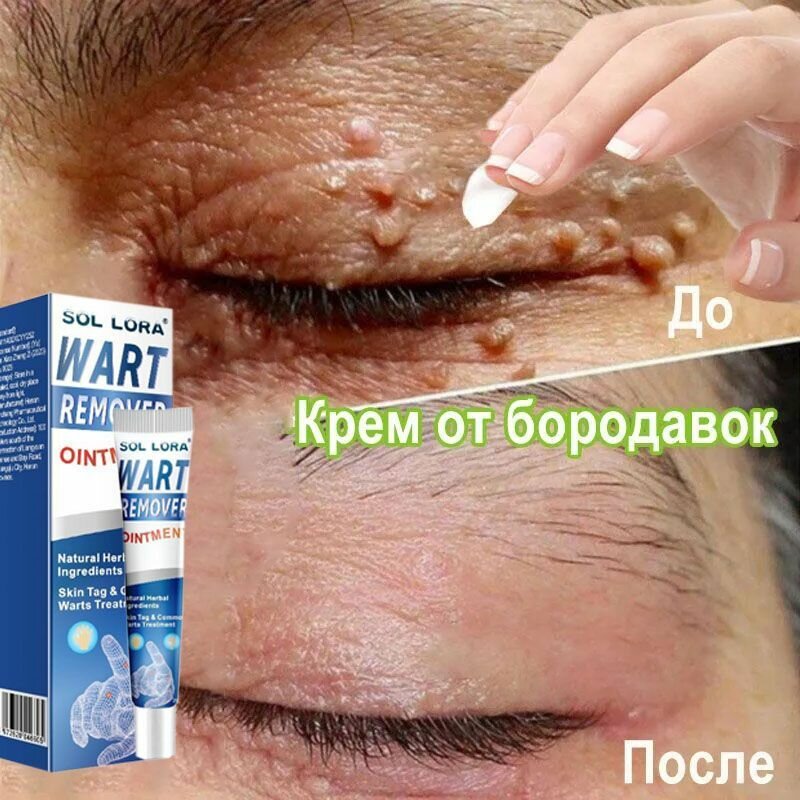 Средство от папиллом и бородавок, для удаления бородавок папиллом, сухих мозолей на ногах и теле, мазь от бородавок