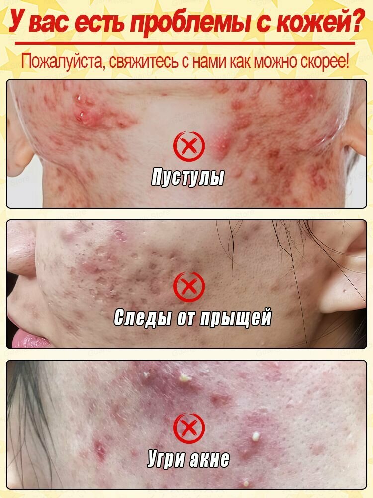 Крем от прыщей / От акне и постакне, для проблемной кожи лица, от шелушения, от покраснений, от псориаза, acnelyse от угрей / 30 мл