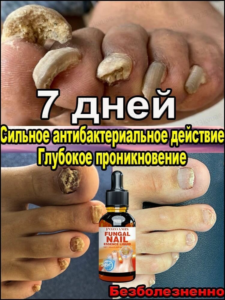 Лечение грибка ногтей на ногах / Уход за ногтями, борьба с пятнами / Противогрибковые препараты