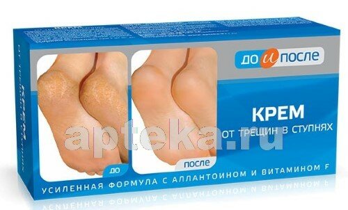 До и после крем от трещин в ступнях 150 мл