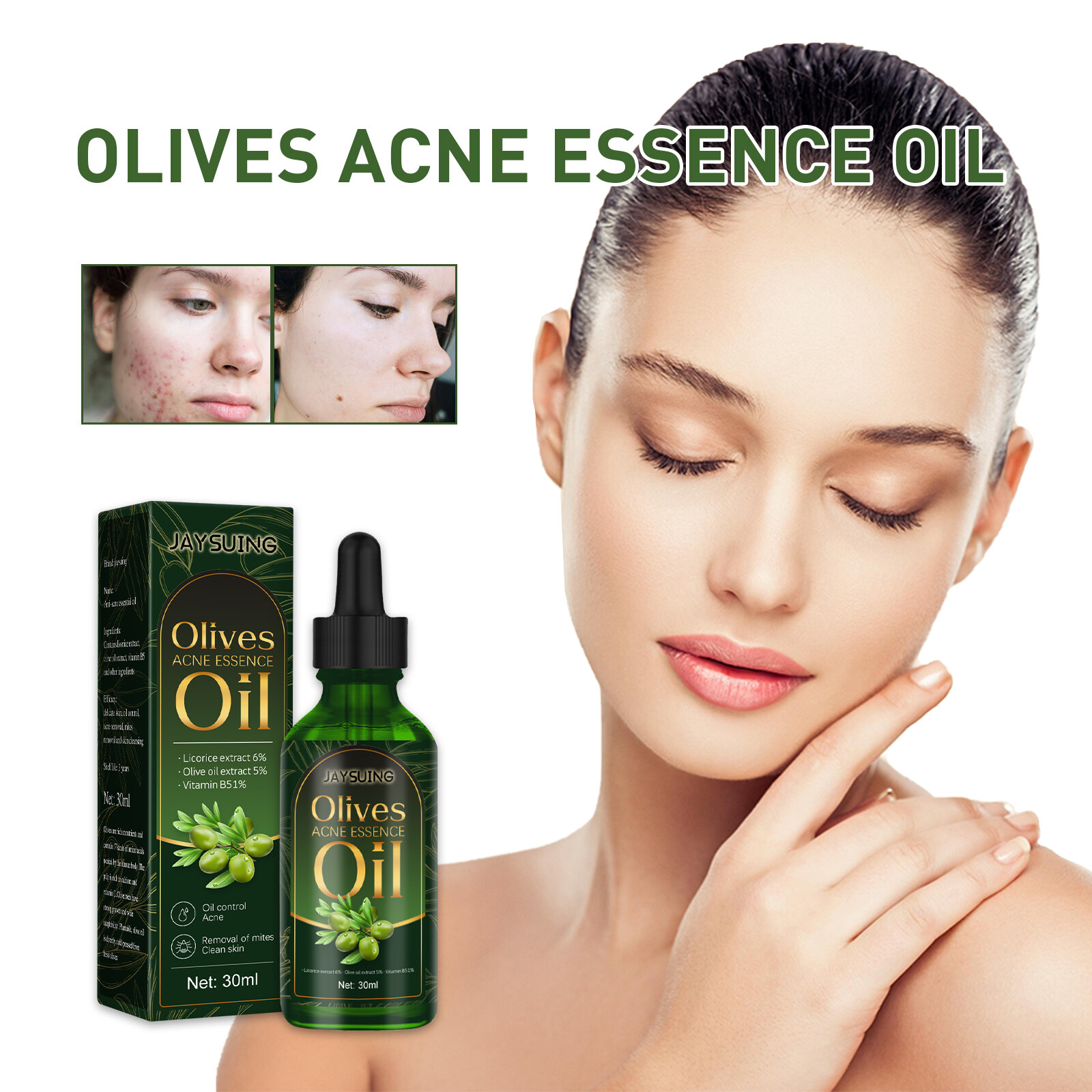 Эфирное масло, очищающее от прыщей, удаляет жирные угри на лице, мягко увлажняет жидкость для устранения угревой сыпи и разбавляет следы от прыщей на лице.