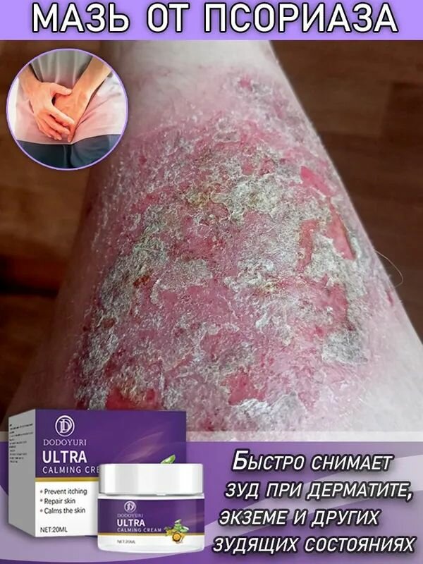 Мазь от псориаза, эффективно снимает зуд, покраснение и дерматит в осенне-зимний период, уменьшает шелушение и трещины, успокаивает и смягчает кожу, 20 г