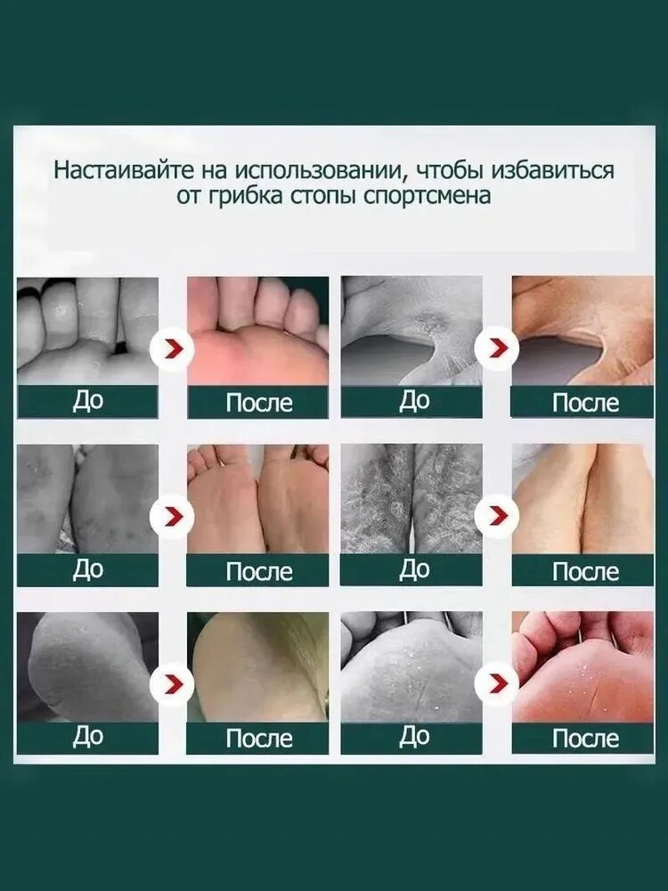 Мазь от грибка ног между пальцев, мазь для лечения зуда и язв, неприятного запаха ног, быстро устраняет воспаление и восстанавливает поврежденную кожу