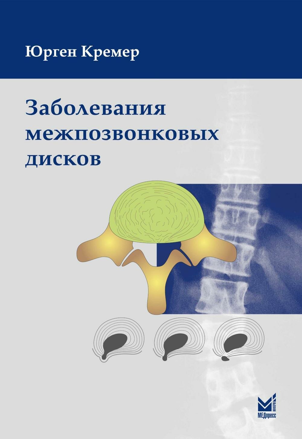 Уценка Заболевания межпозвонковых дисков. 2-е изд. Кремер Ю. МЕДпресс-информ