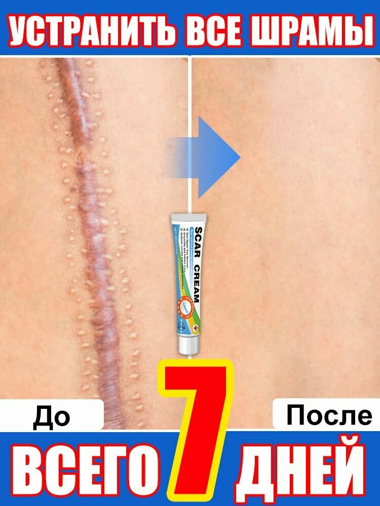 Крем от шрамов, рубцов, растяжек, ожогов, заживления ссадин, травм и пигментации, 60 г