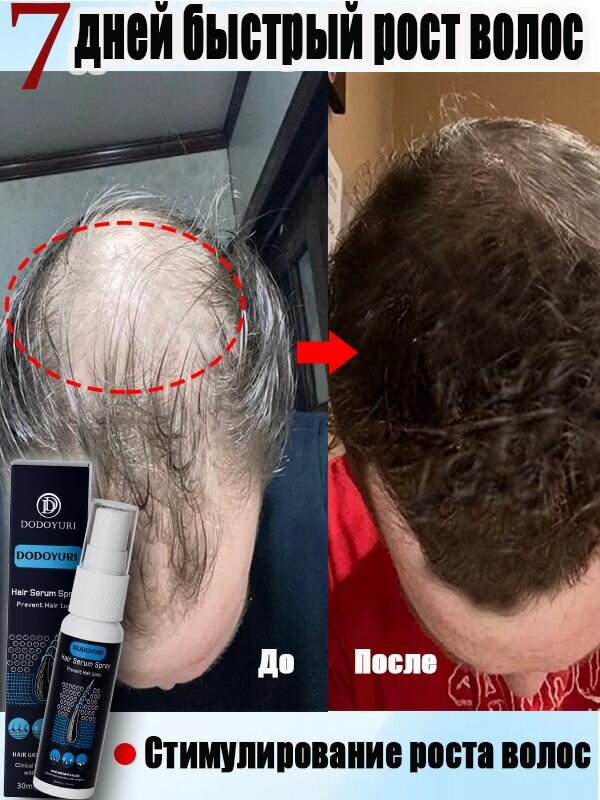 Тоник для роста волос подходит для мужчин и женщин. Увеличивает плотность волос на 90%, 30 мл.