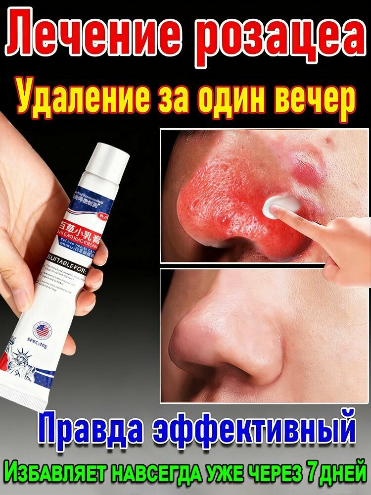 Гипоаллергенная мазь от розацеи - без гормонов, устраняет купероз и постакне на лице,20г