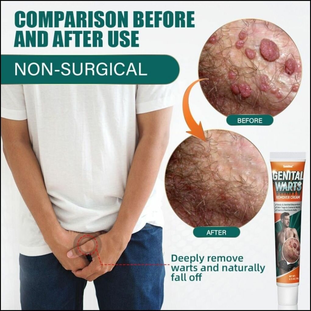 Эксклюзивный крем 20г для интимных кондилом