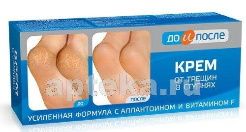 До и после крем от трещин в ступнях 50 мл