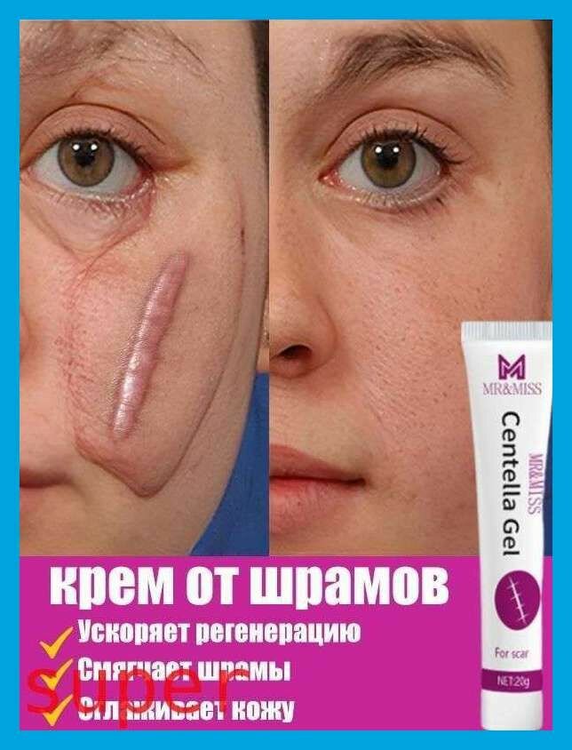 Крем от шрамов и рубцов, гель от прыщей на лице, мазь против ожогов и пигментных пятен и теле, средство от постакне20 г