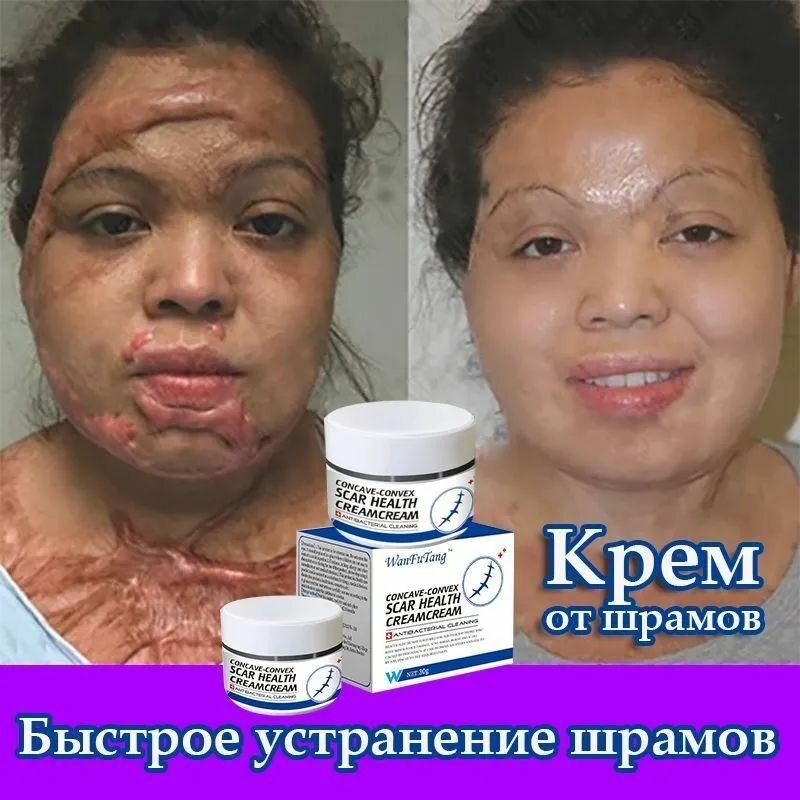 Заживляющий крем от шрамов, растяжки, ожогов, постакне 30 г