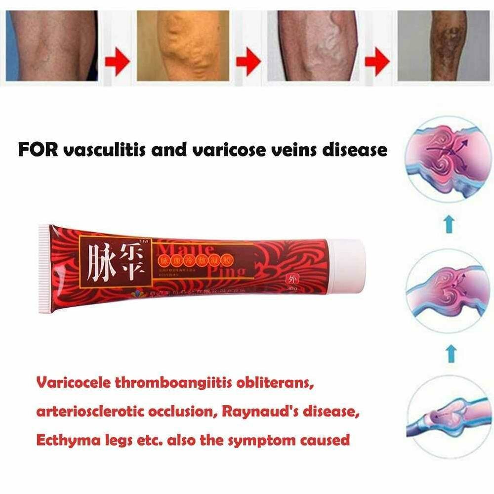 Крем для массажа при варикозном расширении вен, облегчение флебита, ангиита, воспаления кровеносных сосудов, мазь для лечения варикозного расширения вен ног