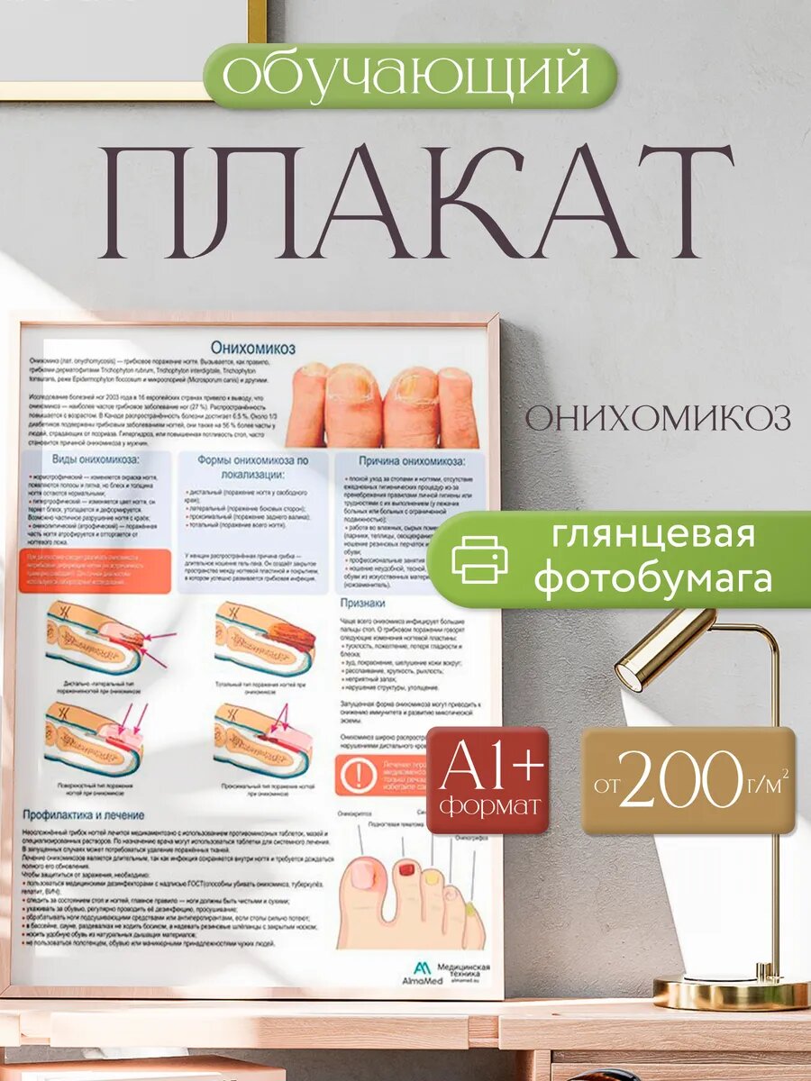 Онихомикоз медицинский плакат глянцевая фотобумага от 200 г/кв. м, размер A1+