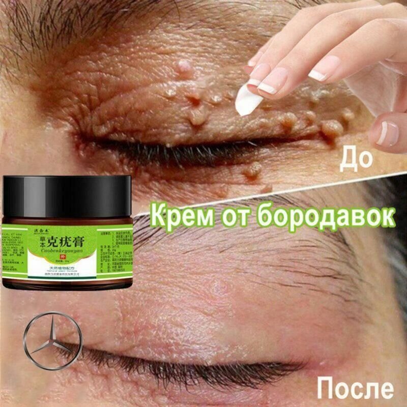 Крем для удаления бородавок и родинок 20g от папиллом и бородавок на проблемной коже лица