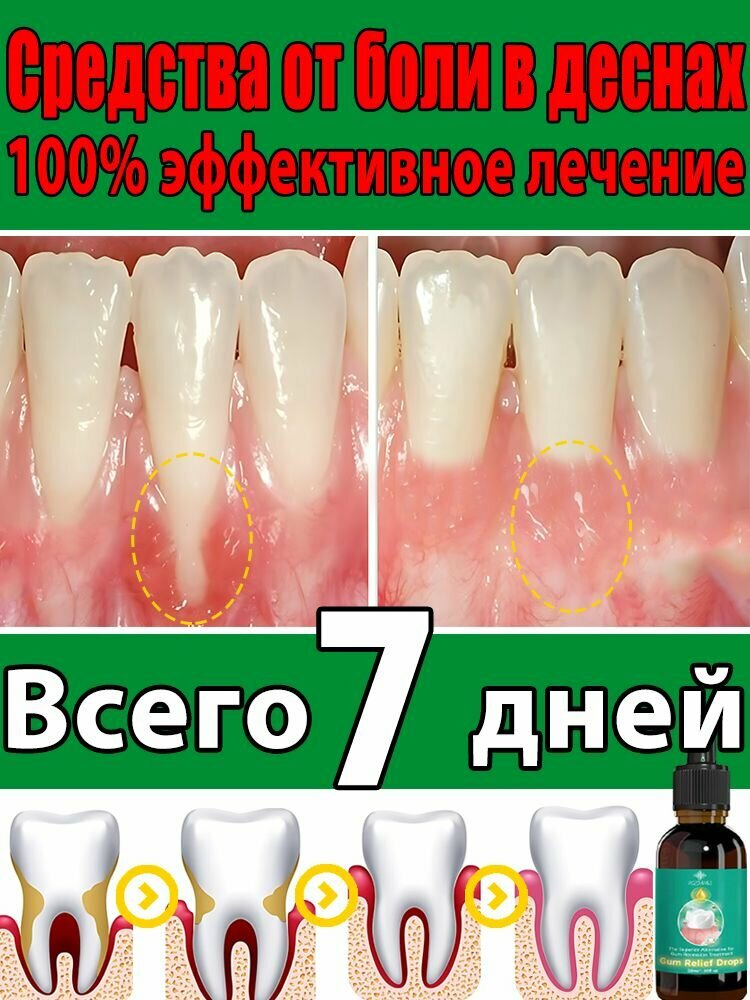 Используется для лечения пародонтита, стоматита, снятия чувствительности и отека десен, восстановления, профилактики и укрепления поврежденных десен, Гигиена полости рта, 30 мл, 10 флакон