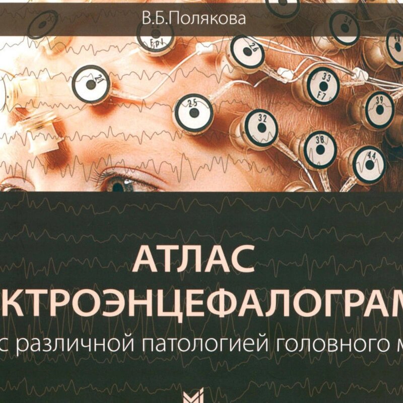 Атлас электроэнцефалограмм детей с различной патологией головного мозга. 2-е изд (Полякова В. Б.)