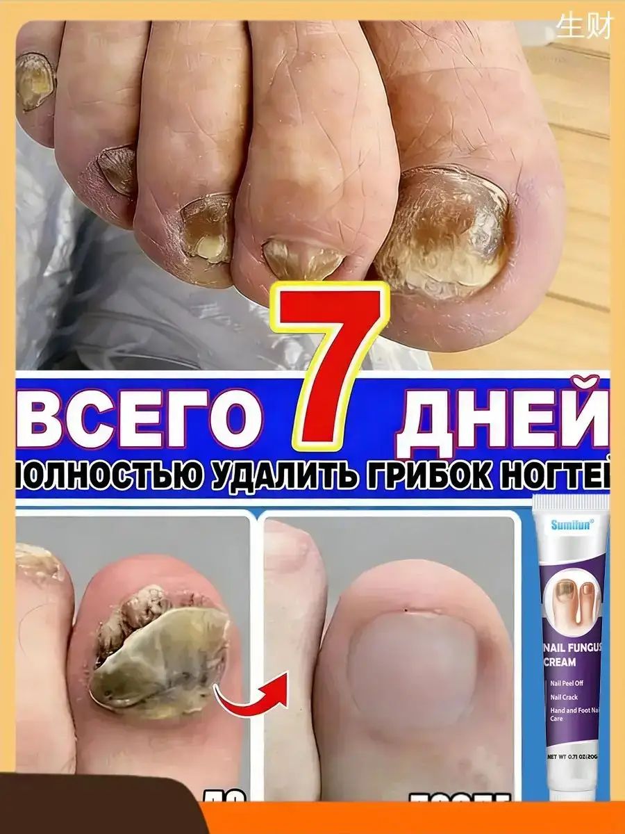 Крем от грибка ногтей и онихомикоза восстанавливает повреждённые ногти устраняет жёлтость и ломкость подходит для рук и ног 20 грамм
