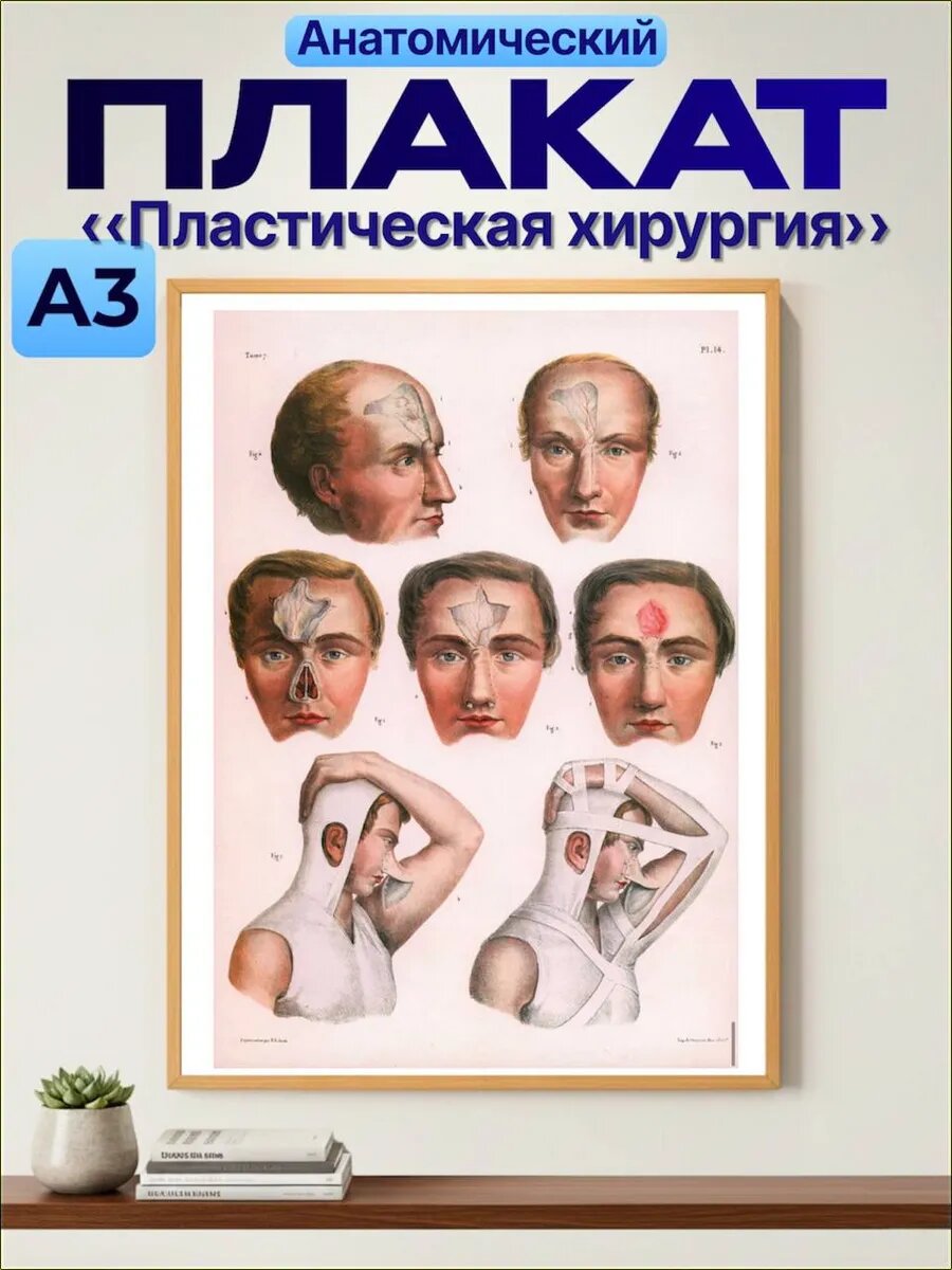 Постер медицинский, круглый стебель Филатова, пластическая хирургия, пластика, А3 анатомия, хирургия