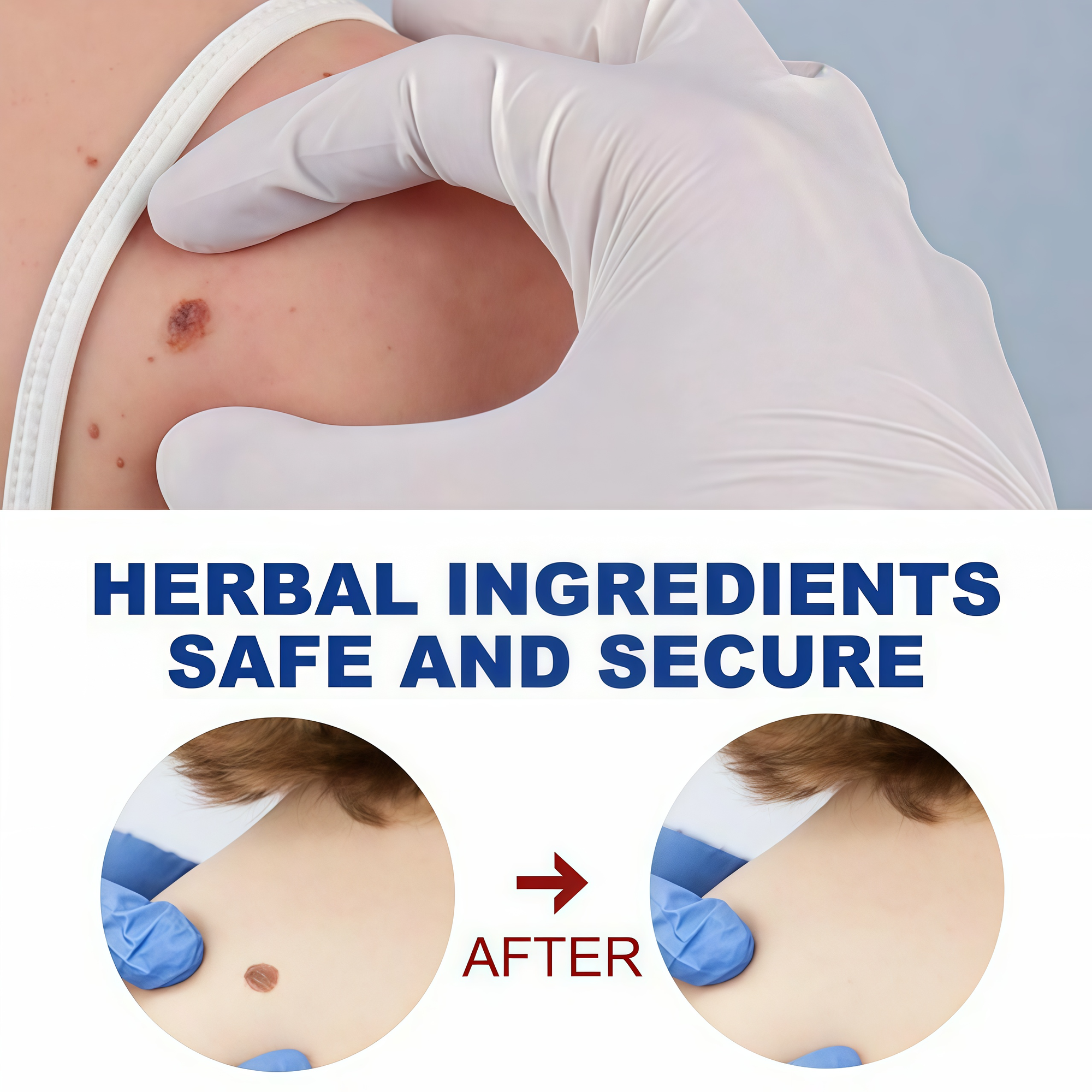 Ручка для удаления родинок и бородавок "Жидкая ручка", для лица