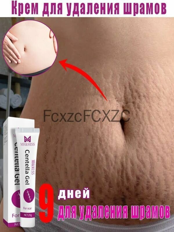 Уникальный крем от стрий
