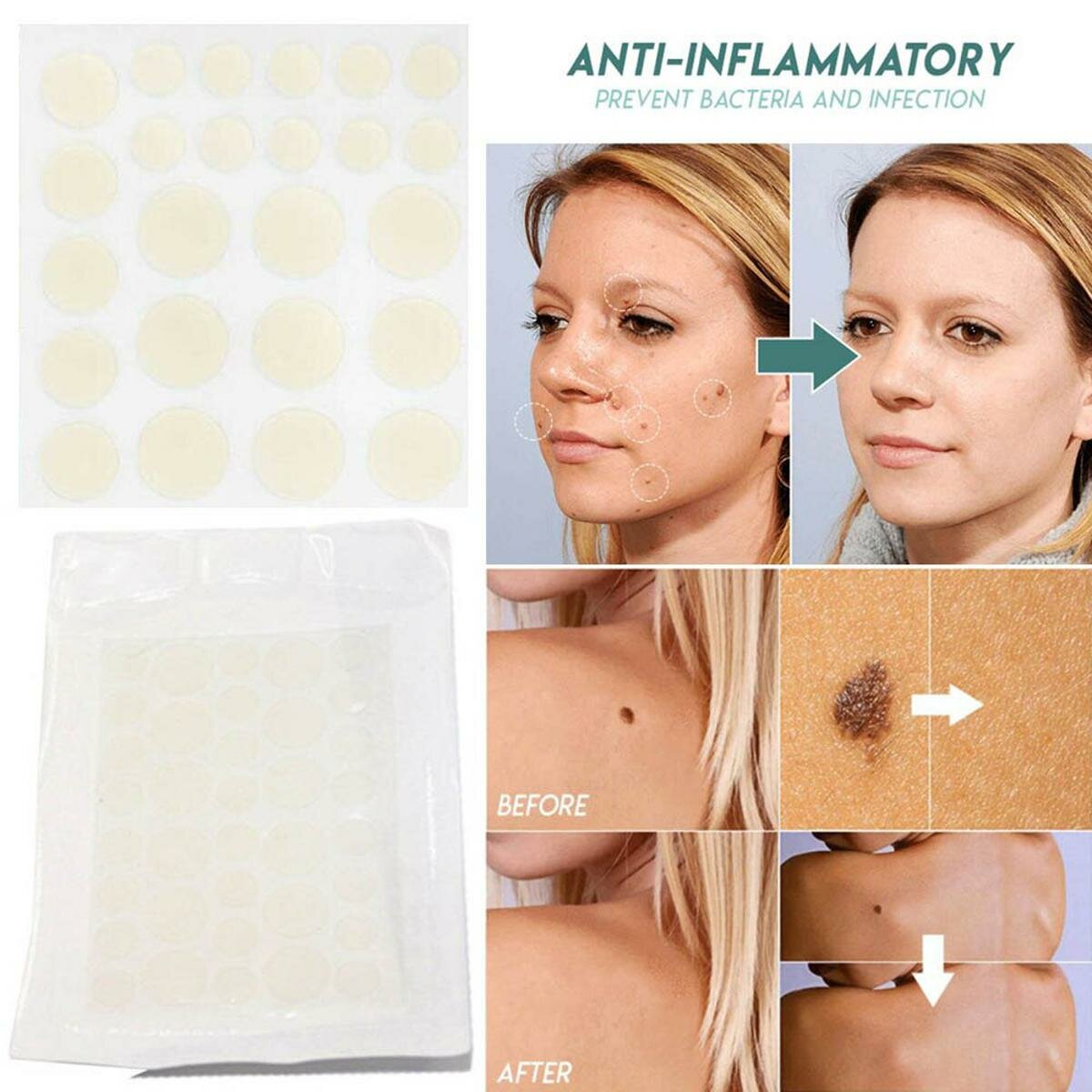 Пластыри для удаления родинок на коже, 24/36 шт. - Крем для лечения угревой сыпи, быстро впитывающиеся пластыри, невидимый противоинфекционный гидрогель