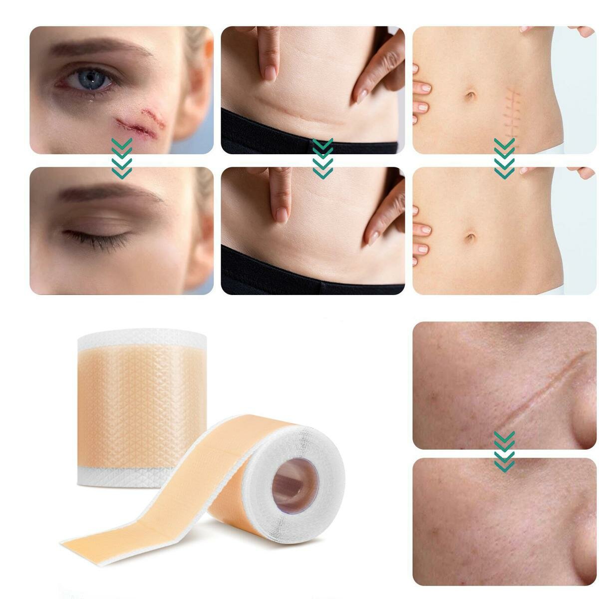 4x50 см силиконовый пластырь от шрамов, повязка на раны, средство для удаления шрамов от прыщей, ожогов, корректоры для ушей, эффективный ремонт поврежденного листа кожи