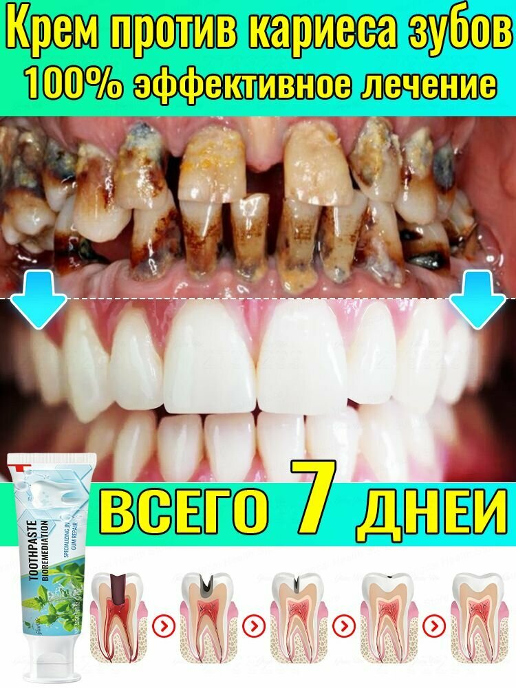 Крем от кариеса зубов улучшает устойчивость эмали к коррозии, разлагает пигмент на зубах, обеспечивает свежее дыхание чтобы предотвратить кариес и вернуть белизну зубов 180 грамм