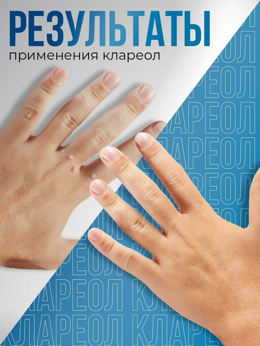 Клареол гель от папиллом / Отшелушивающий чистотел для тела, рук, шеи, бородавок, мазь сухих мозолей, 50 мл