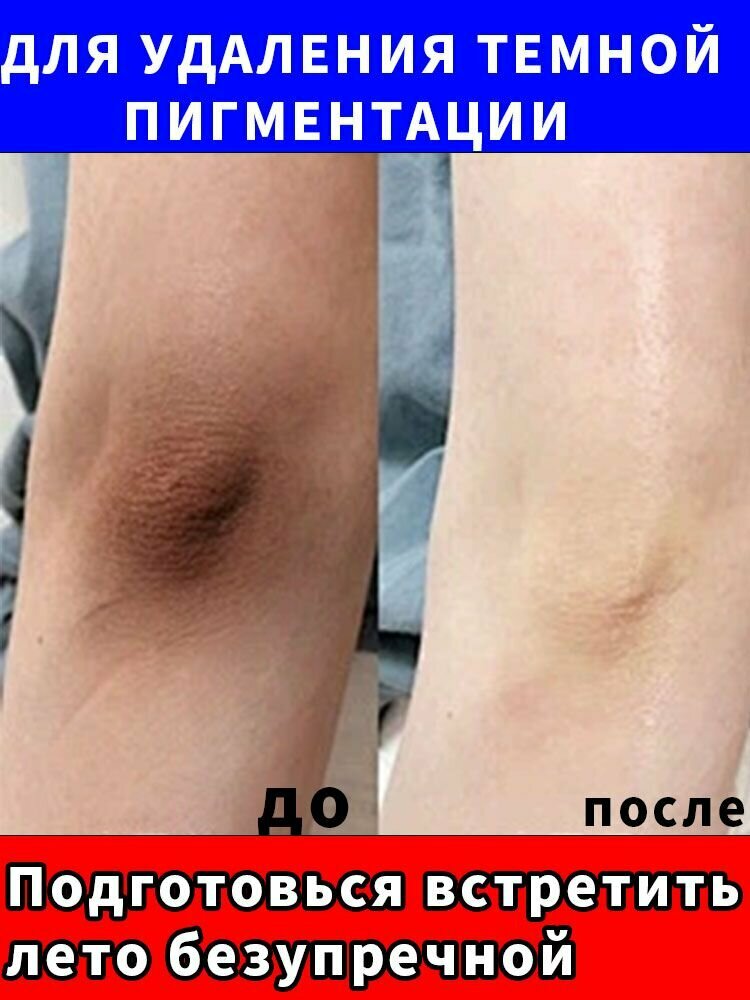 Быстрое отбеливание тёмных зон: крем для подмышек, паха, коленей, локтей и интимных участков ровный тон кожи отбеливающий крем для тёмных зон крем для подмышек и паха крем для коленей и локтей