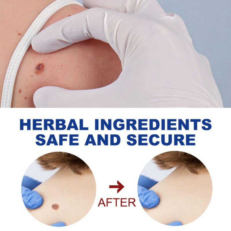 Ручка для удаления родинок Mireth Home, для лица, 12,1x1,2x13 см