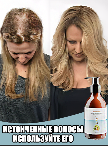 Шампунь от псориаза на голове с экстрактом имбиря, средство для мужчин и женщин, 300 мл