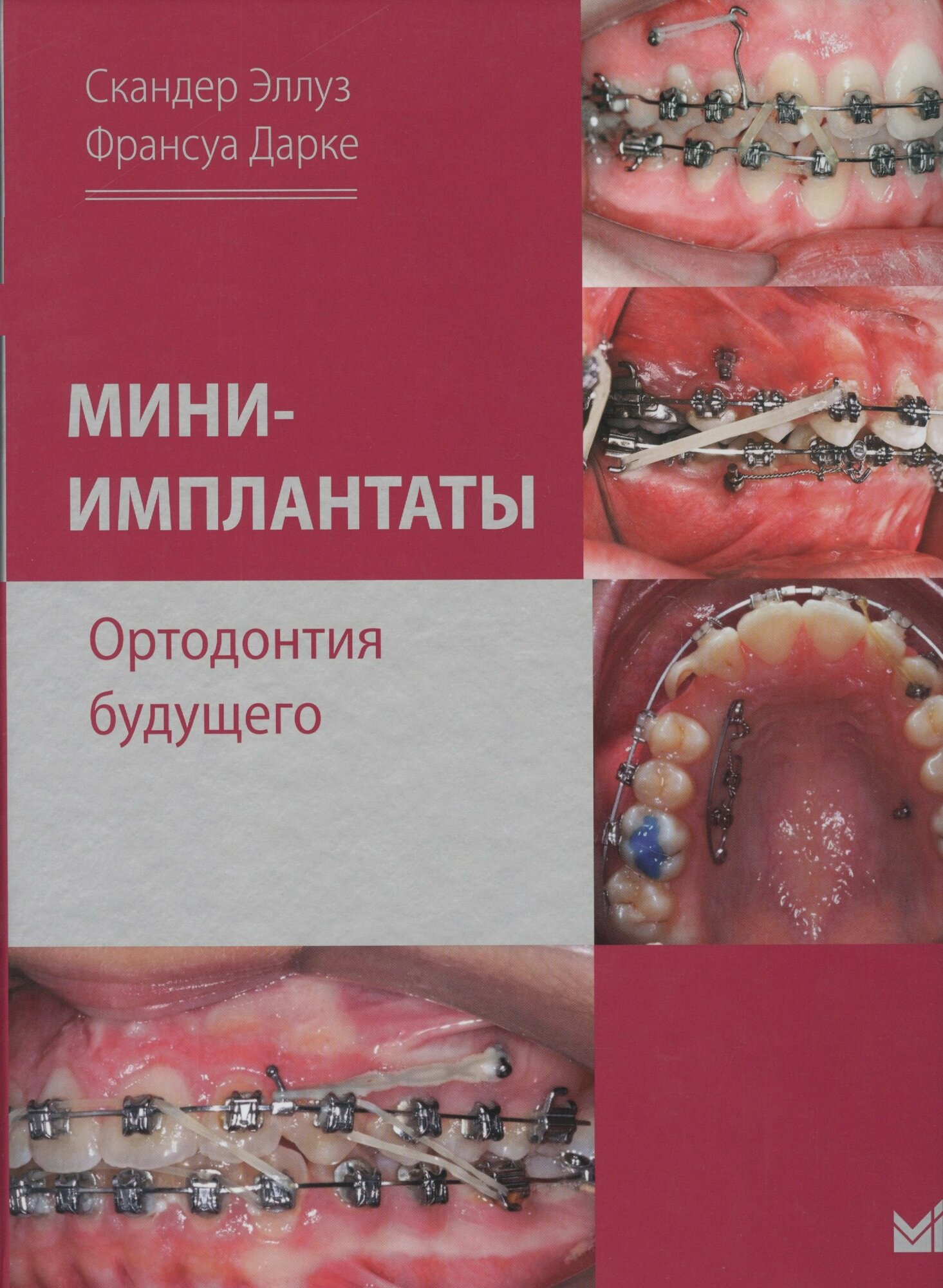 Книга: "Мини-имплантаты. Ортодонтия будущего." от Эллуз С, русский язык, Специализированные отрасли медицины