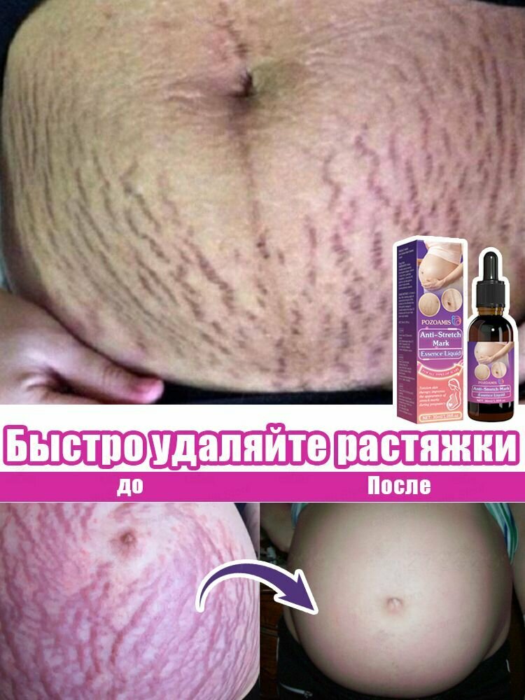 Это масло для лечения растяжек специально разработано для беременных женщин и людей с ожирением. Оно удаляет растяжки, восстанавливает кожу, уменьшает целлюлит и возвращает коже эластичность. 300 мл