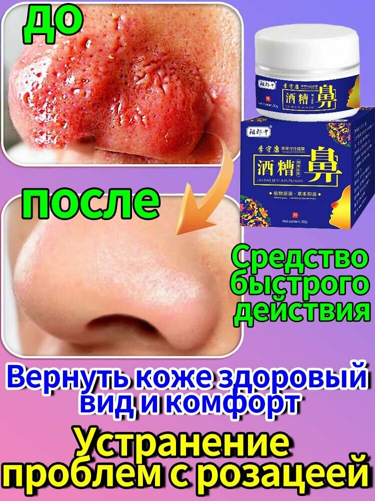 Фитол-9 Куперозан-Fito Крем от купероза на лице, антикупероз, средство от сосудистых звездочек, от покраснений, розацеа, успокаивающий увлажняющий крем для лица с мочевиной витамин С Е, пантенол