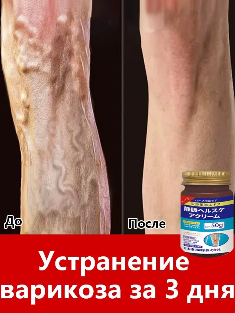 Крем от варикозного расширения вен, 50 г снимает боль улучшает циркуляцию уменьшает расширение вен