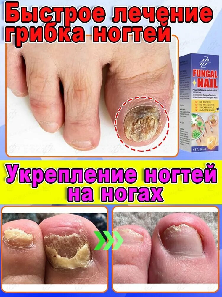 Масло от грибка ногтей на ногах, противогрибковое средство с маслом чайного дерева, средство от онихомикоза для восстановления ногтевой пластины, уход за ногтями и кутикулой, 10 мл