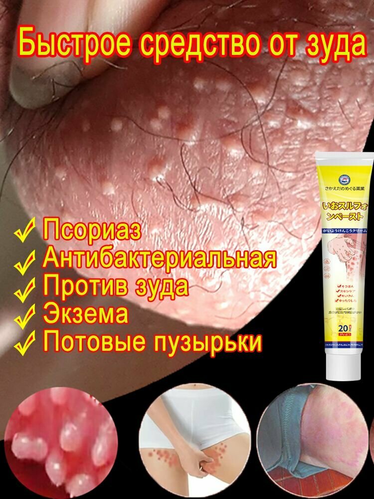 Тело крем от псориаза Противозудное, антибактериальное средство при экземе и герпесе