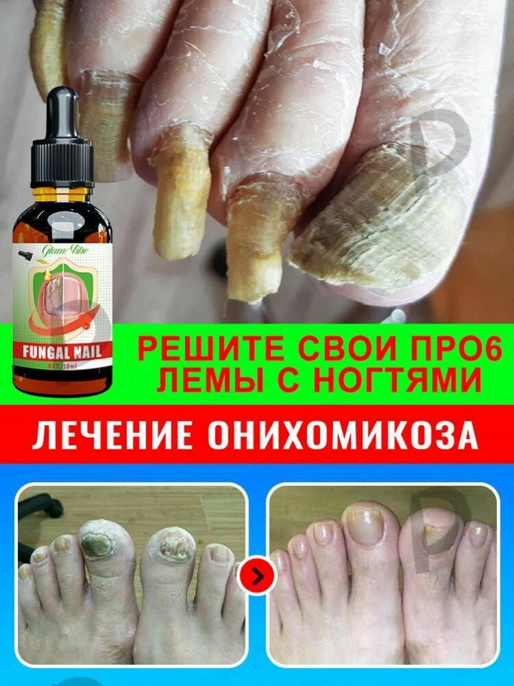 Используется для лечения грибка ногтей на ногах. Удаление грибковых инфекций, противогрибковые средства, Онихолизис , Ремонт ногтей. 10 мл