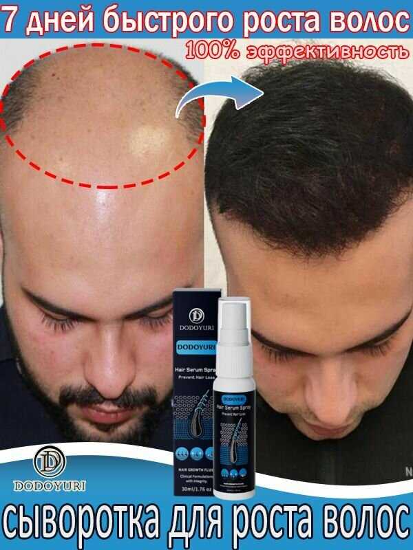 Спрей для роста волос и против выпадения, натуральной травяной эссенции, Профессиональное средство от выпадения 30 мл