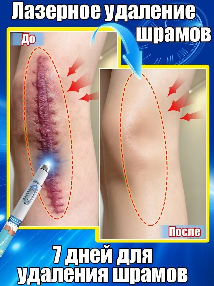 Лазерная ручка для удаления шрамов, используемая для удаления шрамов, растяжек, травм и пигментации, устранения рубцов, восстановления гладкости кожи и быстрого заживления. одна лазерная ручка