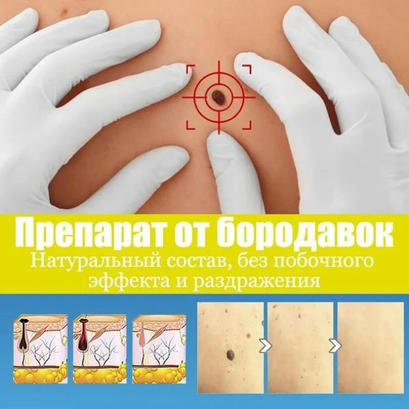 Эксклюзивный препарат для устранения папиллом, бородавок и сухих мозолей на теле и ногах, объем 20 грамм