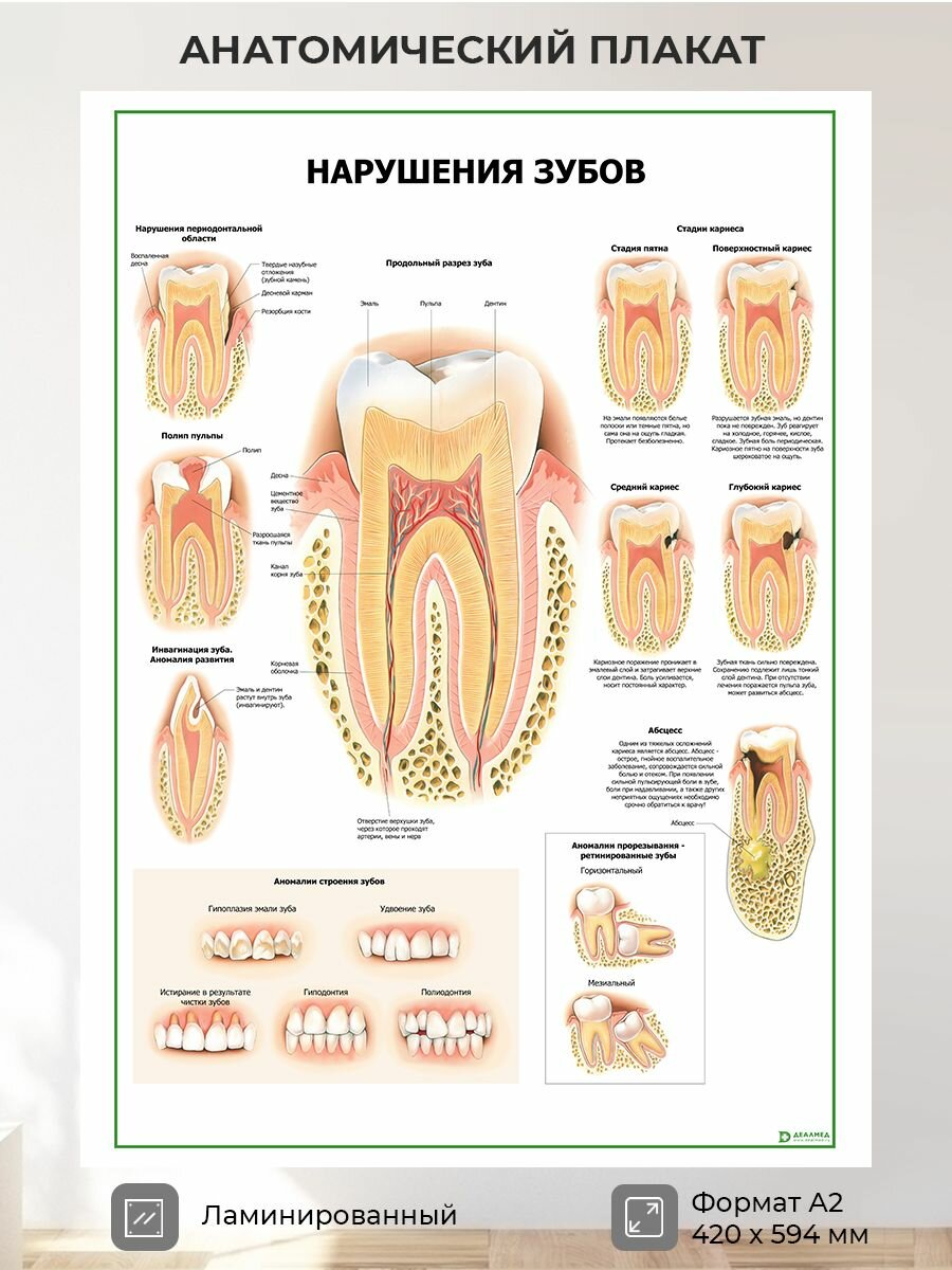 Обучающий медицинский плакат Нарушение зубов А2