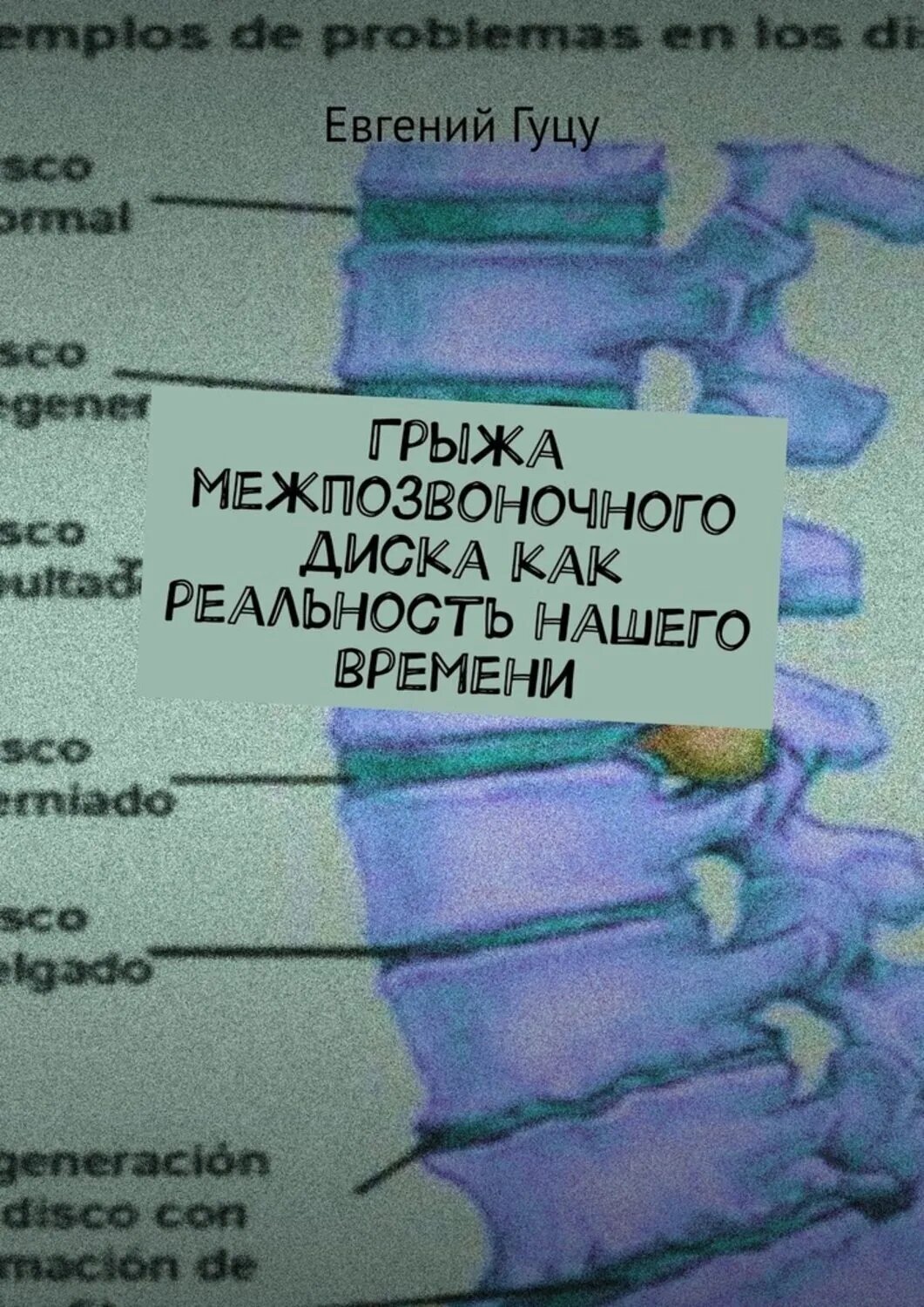 Грыжа межпозвоночного диска как реальность нашего времени [Цифровая книга]