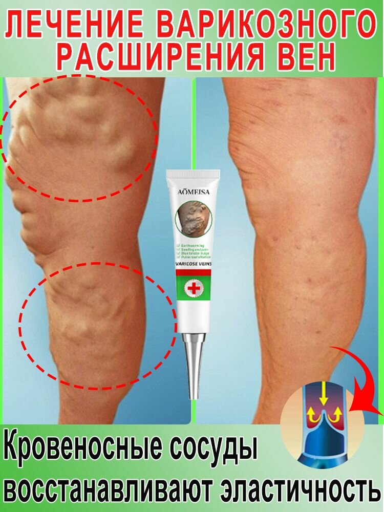 Мазь от варикозного расширения вен, подходит для лечения расширенных кровеносных сосудов, отеков ног, снятия боли и усталости, а также уменьшения зуда. 30 мл