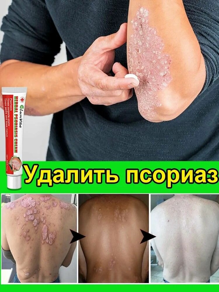 Крем от псориаза для лечения псориаза, дерматита и экземы. Восстанавливает кожный барьер, снимает зуд и дискомфорт. 60 мл.