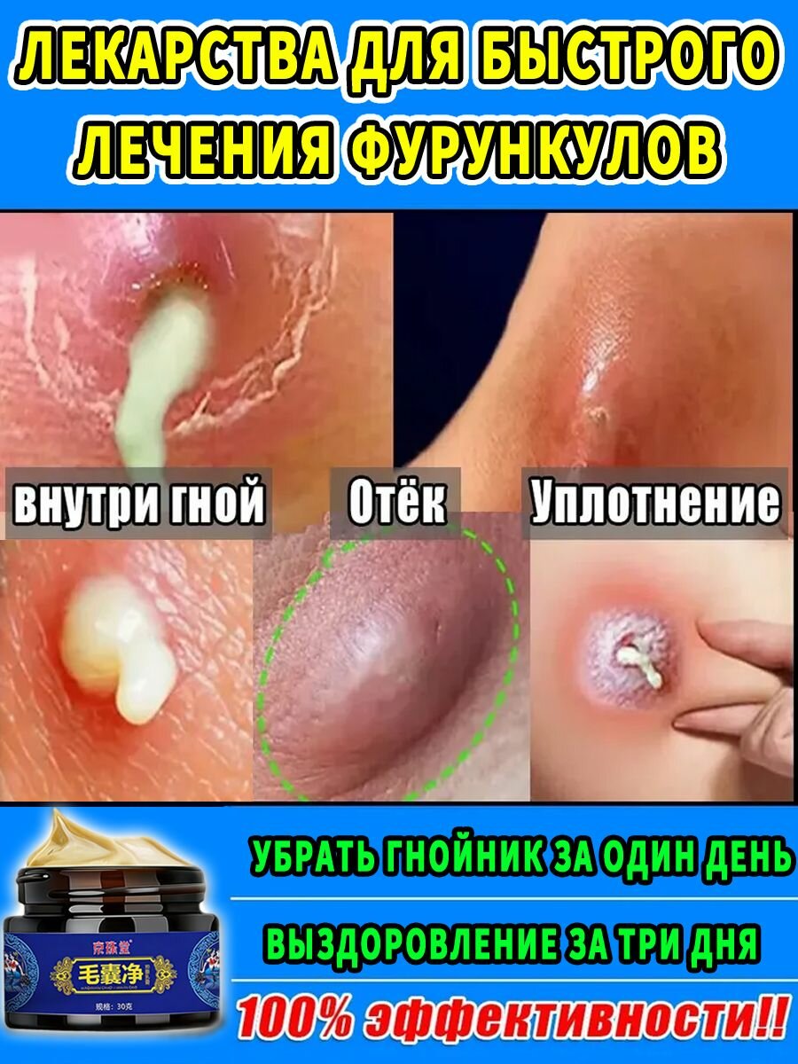 Китайская мазьВытягивающий от фурункулов, акне и гнойниковснимает воспаление и покраснение при акне и чириях