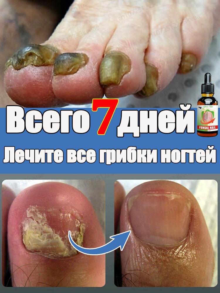 Лечение микоза ногтей на ногах, подходит для больных ногтей, рогового слоя и кожи. Безболезненное выздоровление, устранение первопричины заболевания